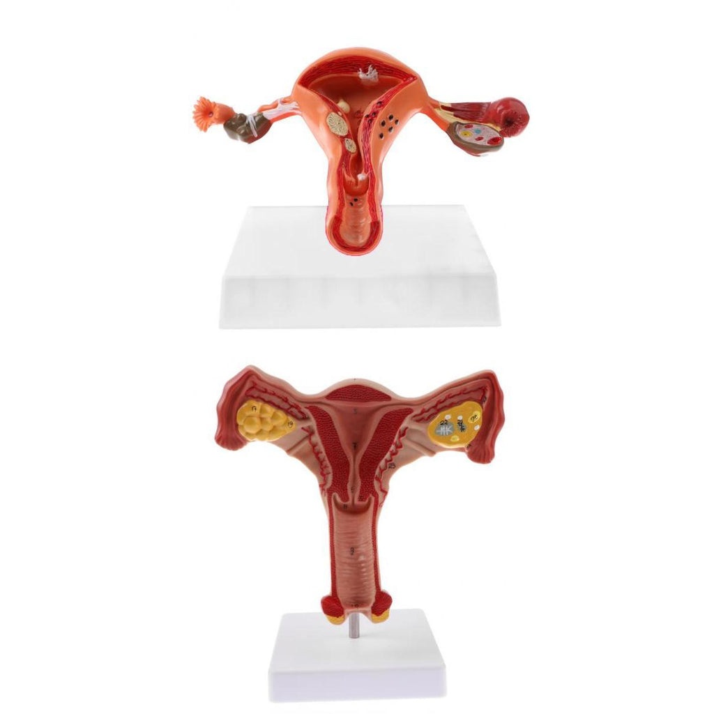 ⚡️Buy Maxbell 1:1 Human Female Uterus Ovary Pathological +Normal Model ...